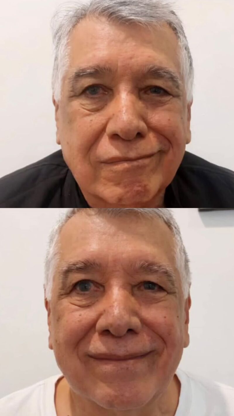 Recomendaciones Parálisis Facial - Terapia Fisica Costa Rica y ...